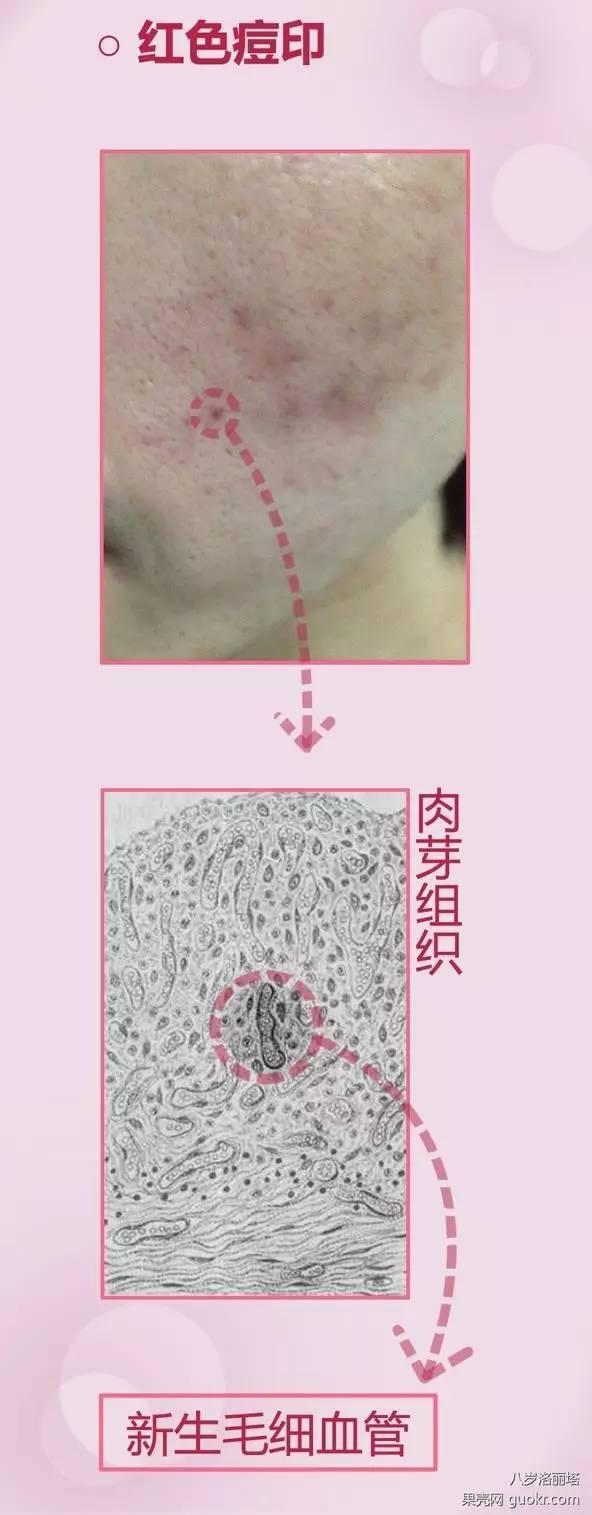 各种类型痘印图片痘印和痘疤图片痘疤是什么样子的图片第2页大山谷图库