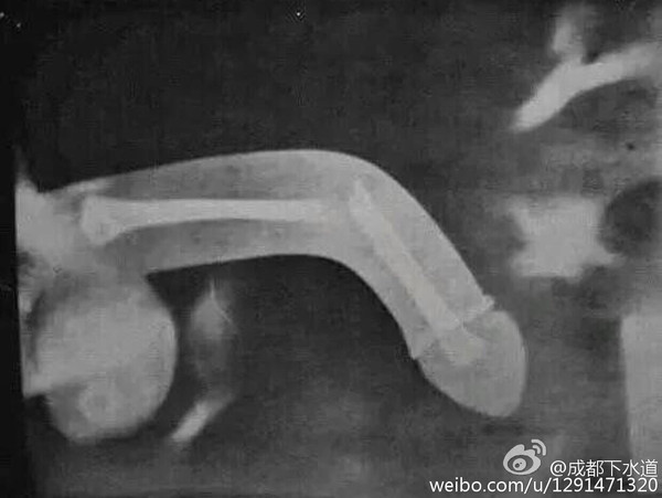 枪打断了怎么办?谈阴茎折断的诊断及治疗